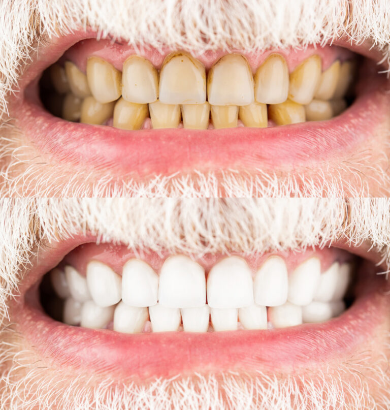 Tooth and Lies – Separating Dental Myth From Fact | Smile Science ...