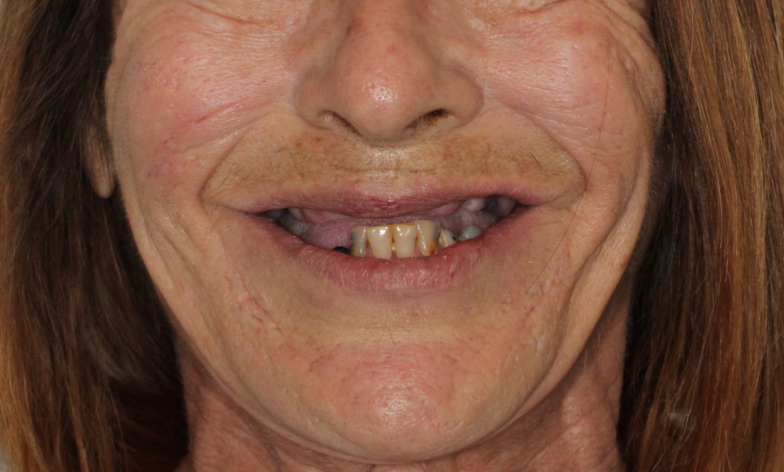 Zygomatic Implants | Smile Science Dental Spa