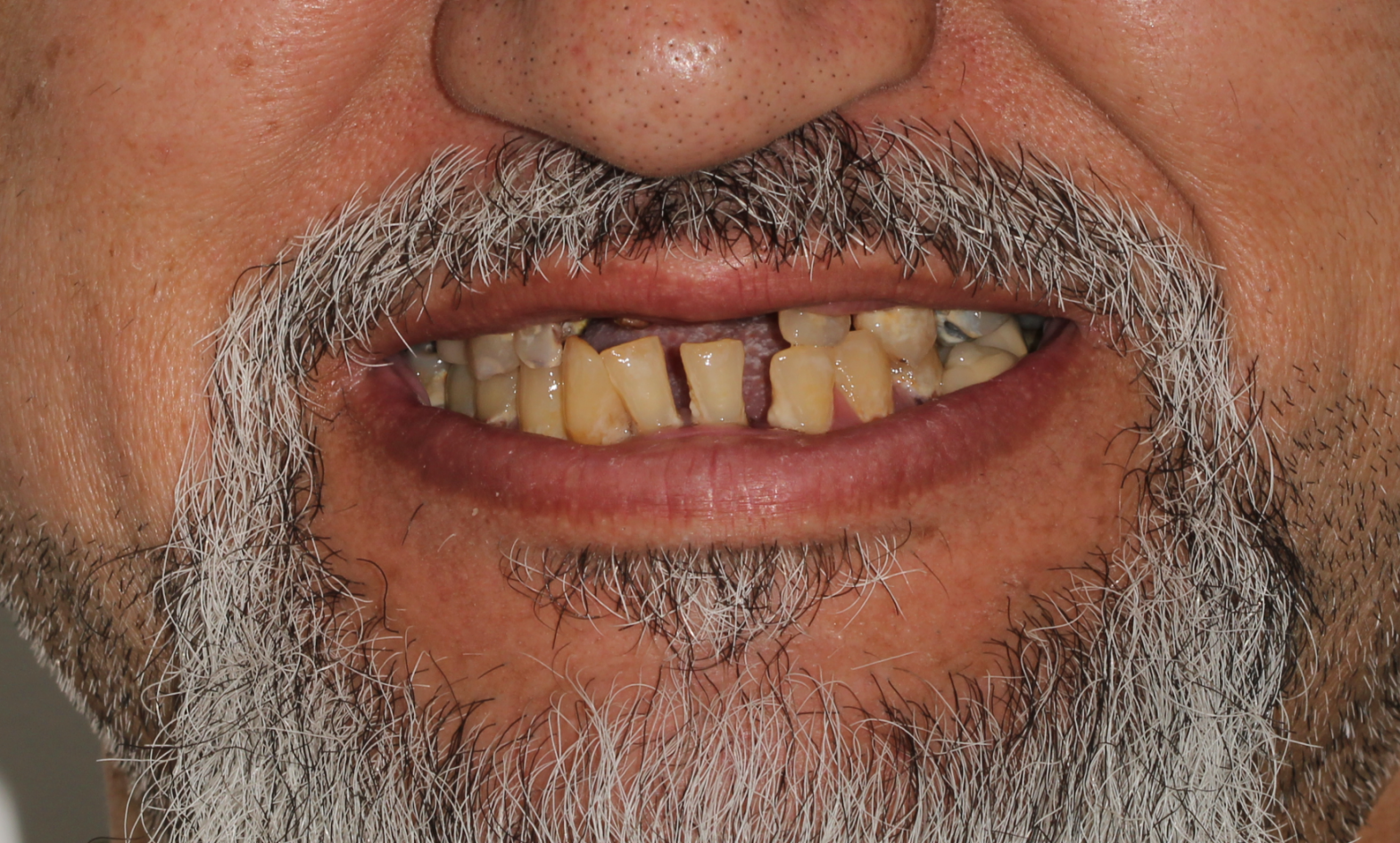 Zygomatic Implants | Smile Science Dental Spa